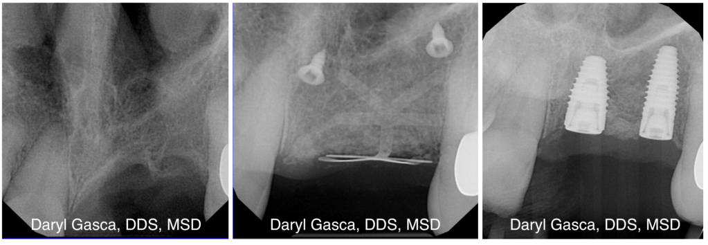 Before and After – Black Diamond Periodontics & Implant Dentistry